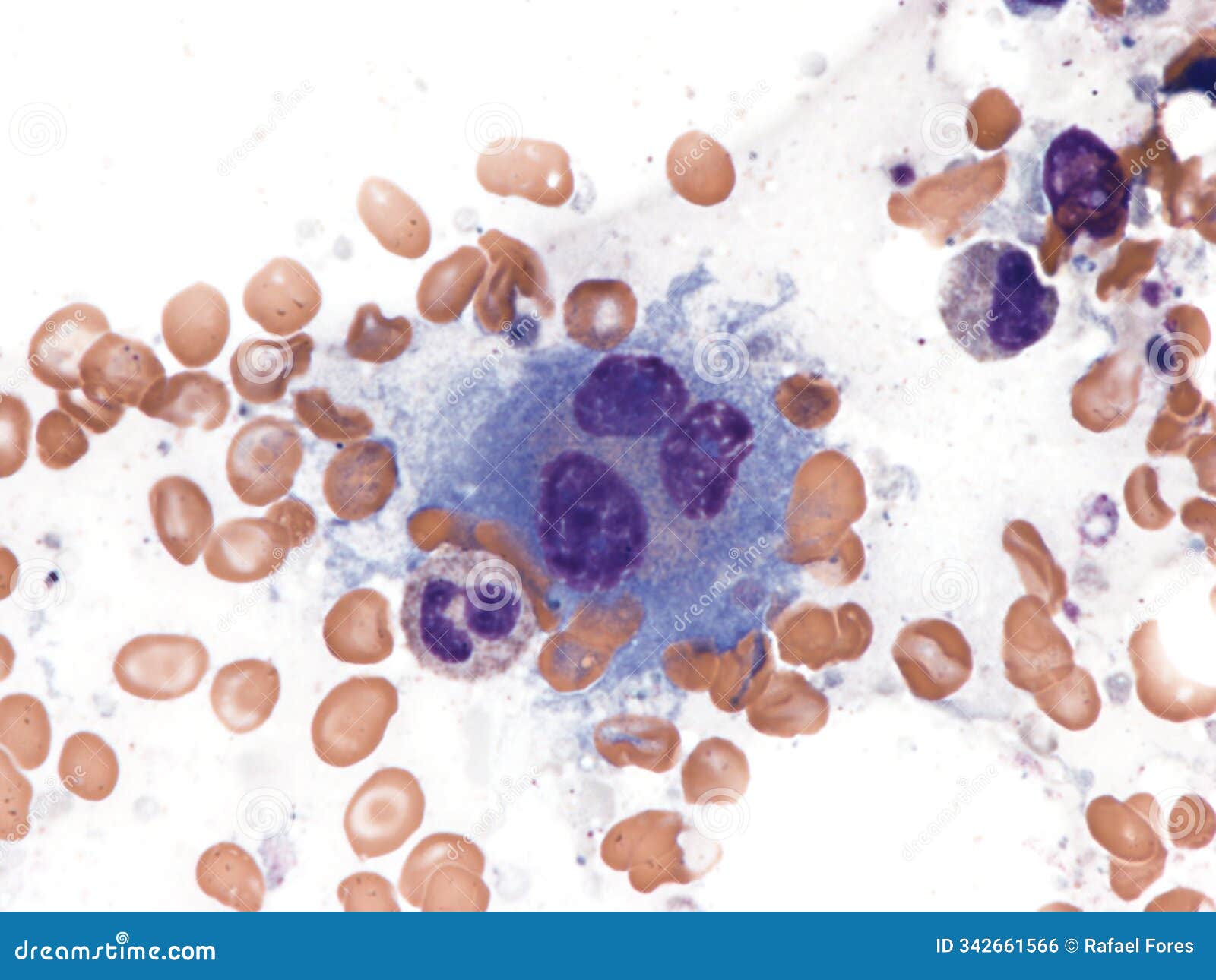 Multinucleated Plasma Cell. Multiple Myeloma. Stock Photo - Image of ...
