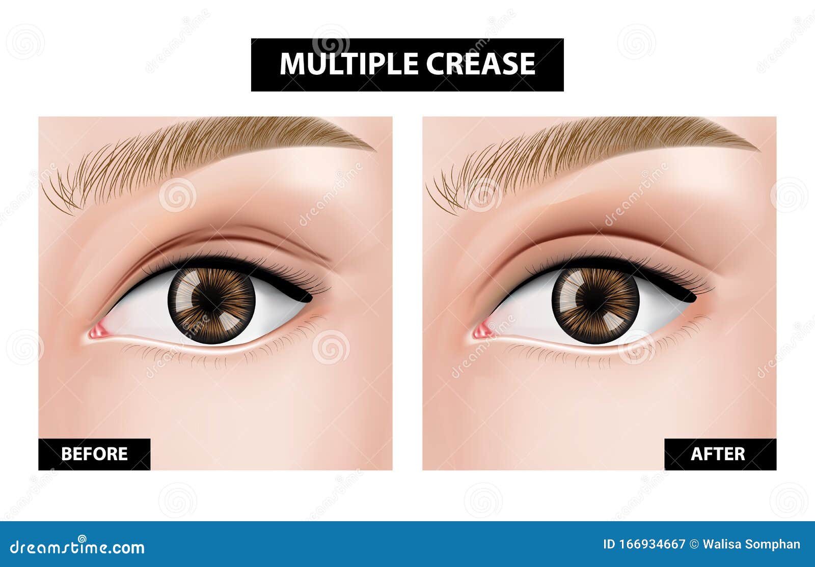 Multiple crease of eyelid stock illustration. Illustration of level ...