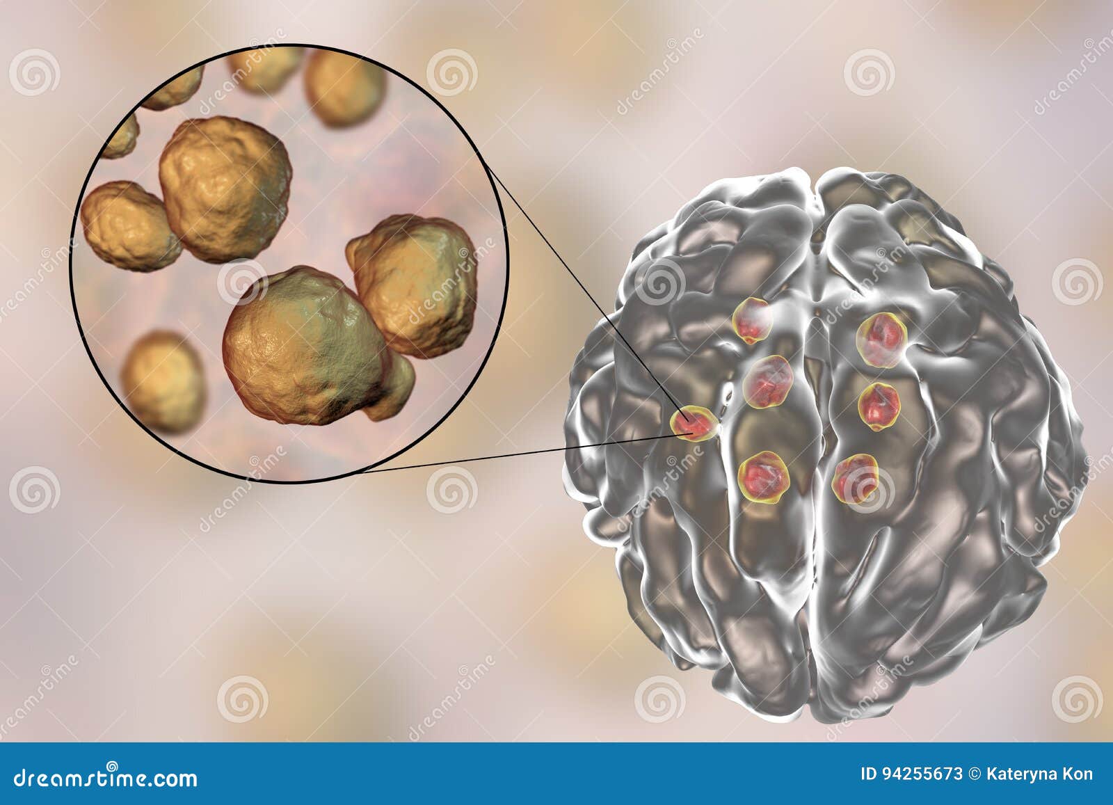 Multiple Cryptococcal Cysts in Brain Stock Illustration - Illustration ...