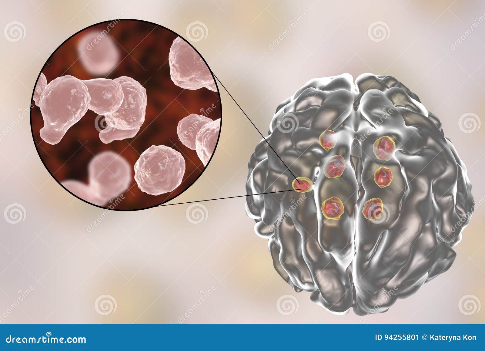 Multiple Cryptococcal Cysts in Brain Stock Illustration - Illustration ...