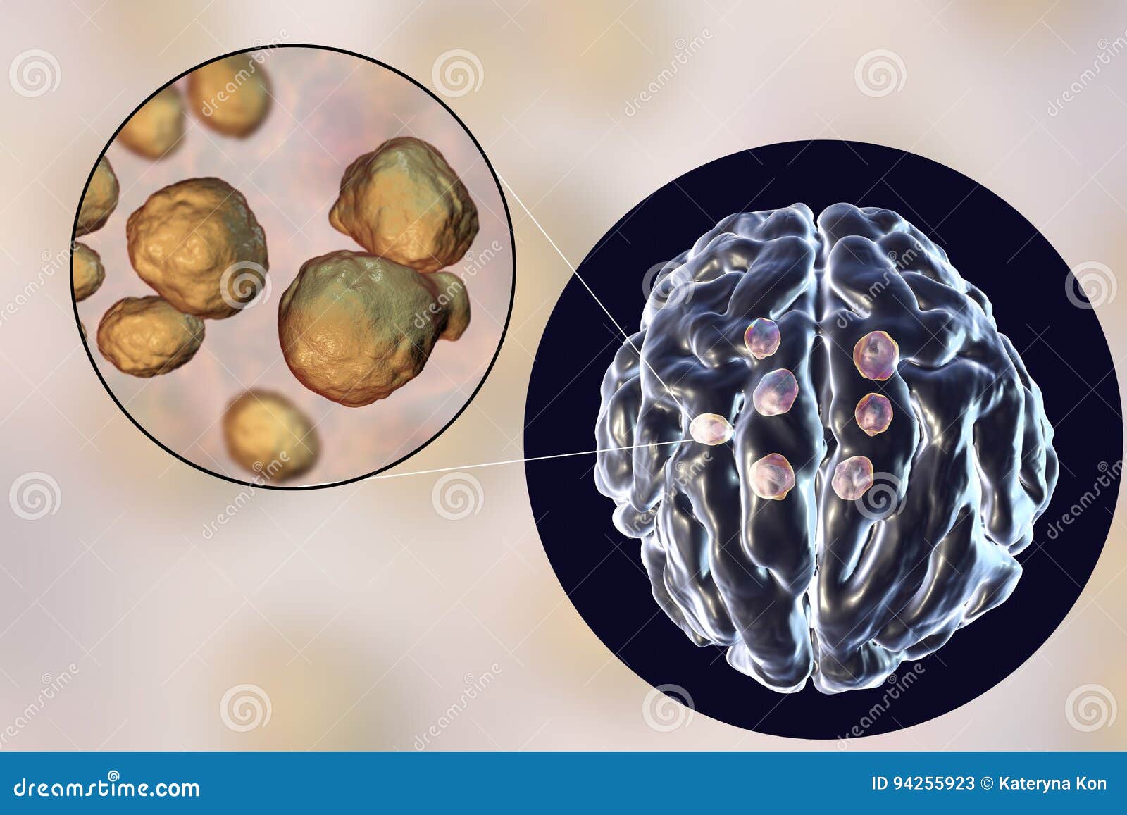 Multiple Cryptococcal Cysts in Brain Stock Illustration - Illustration ...
