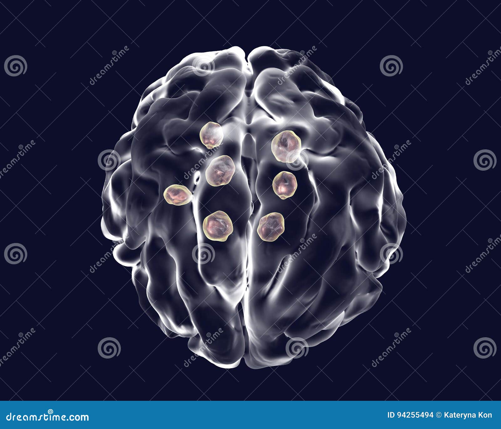 Multiple Cryptococcal Cysts in Brain Stock Illustration - Illustration ...
