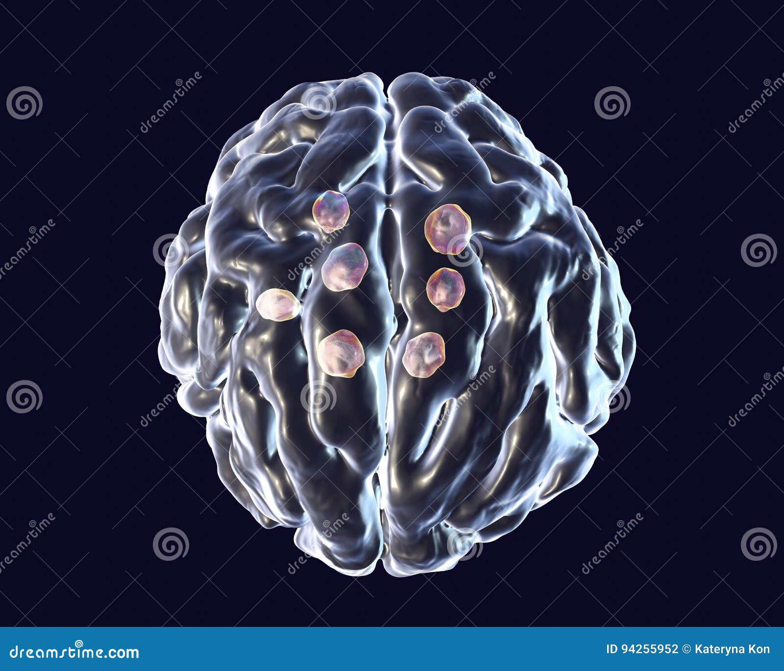 Multiple Cryptococcal Cysts in Brain Stock Illustration - Illustration ...