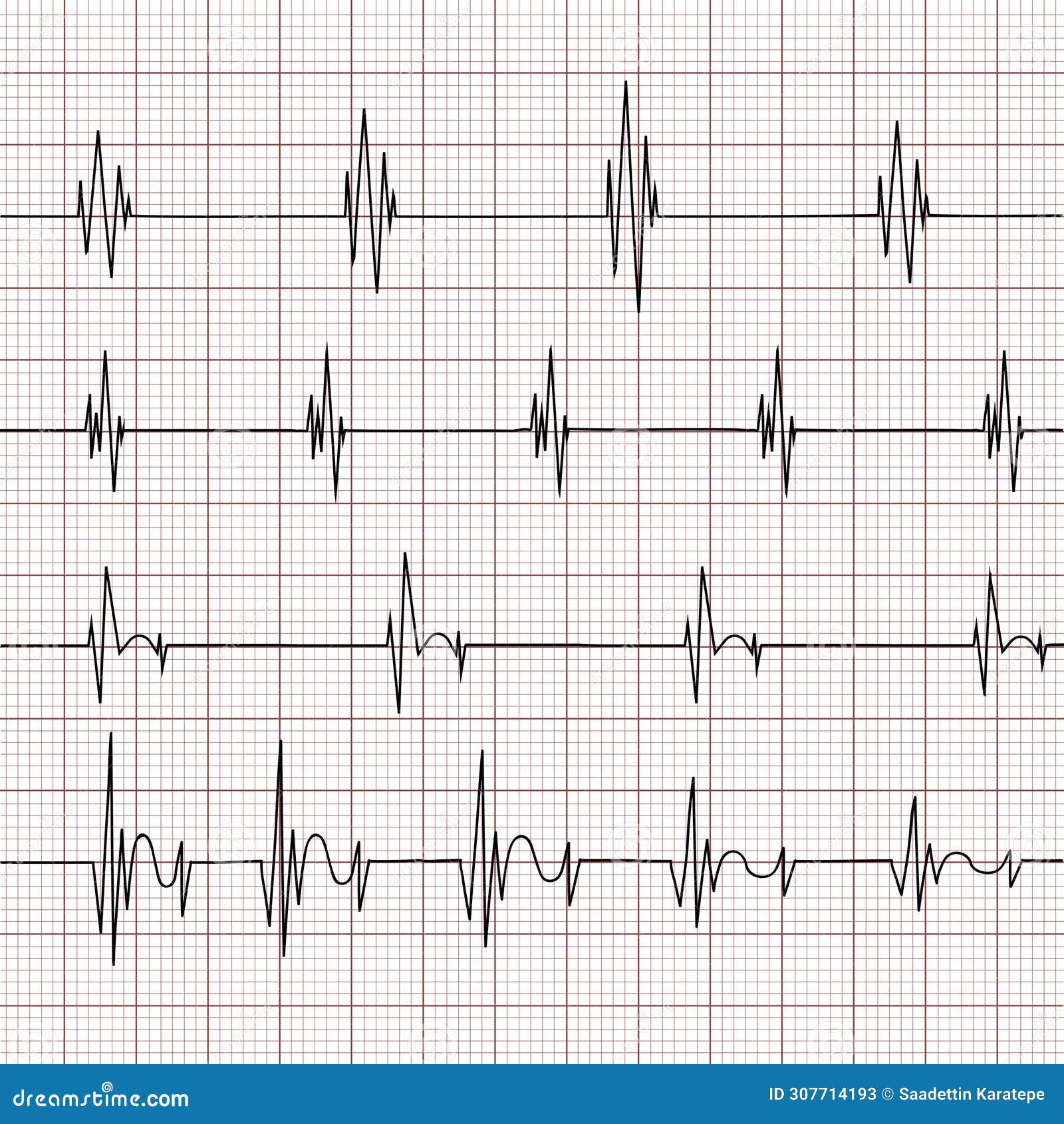 Multiple EKG (Electrocardiogram) Graphs on a Grid Background. Stock ...