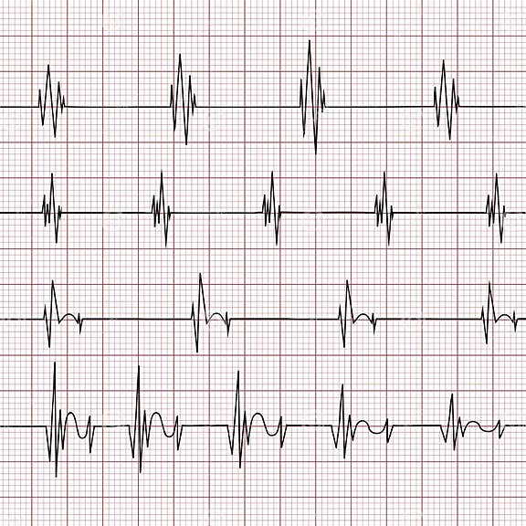 Multiple EKG (Electrocardiogram) Graphs on a Grid Background. Stock ...