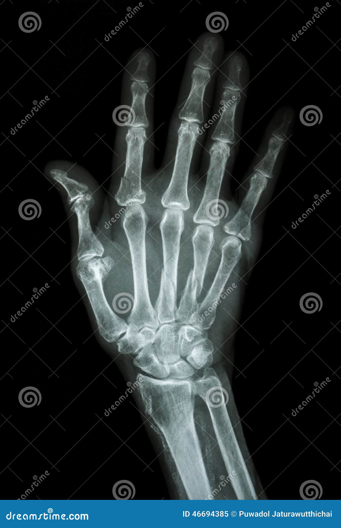 Fracture Index Proximal Phalanx Showing X-ray Hand. Royalty-Free Stock ...