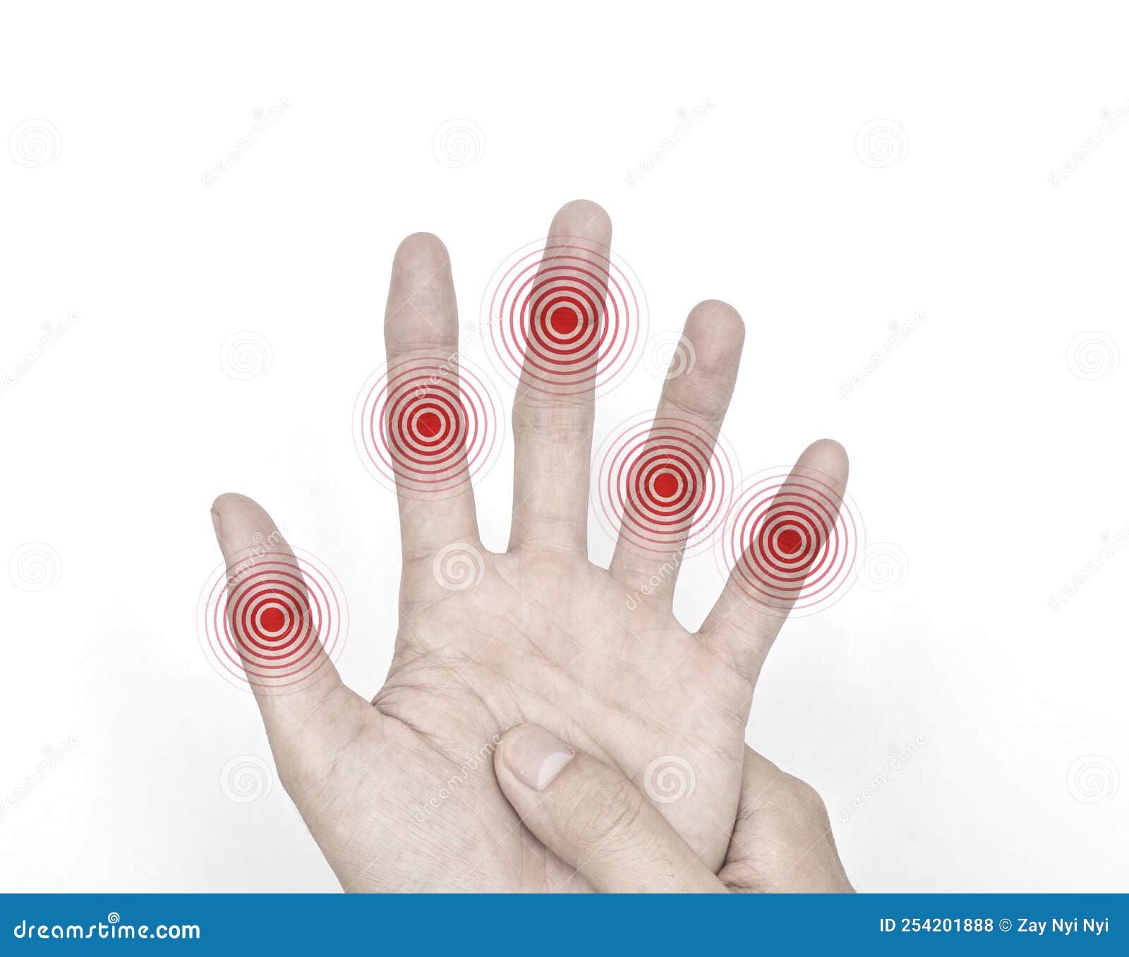 Multiple Joints Inflammation. Concept of Rheumatic Arthritis ...