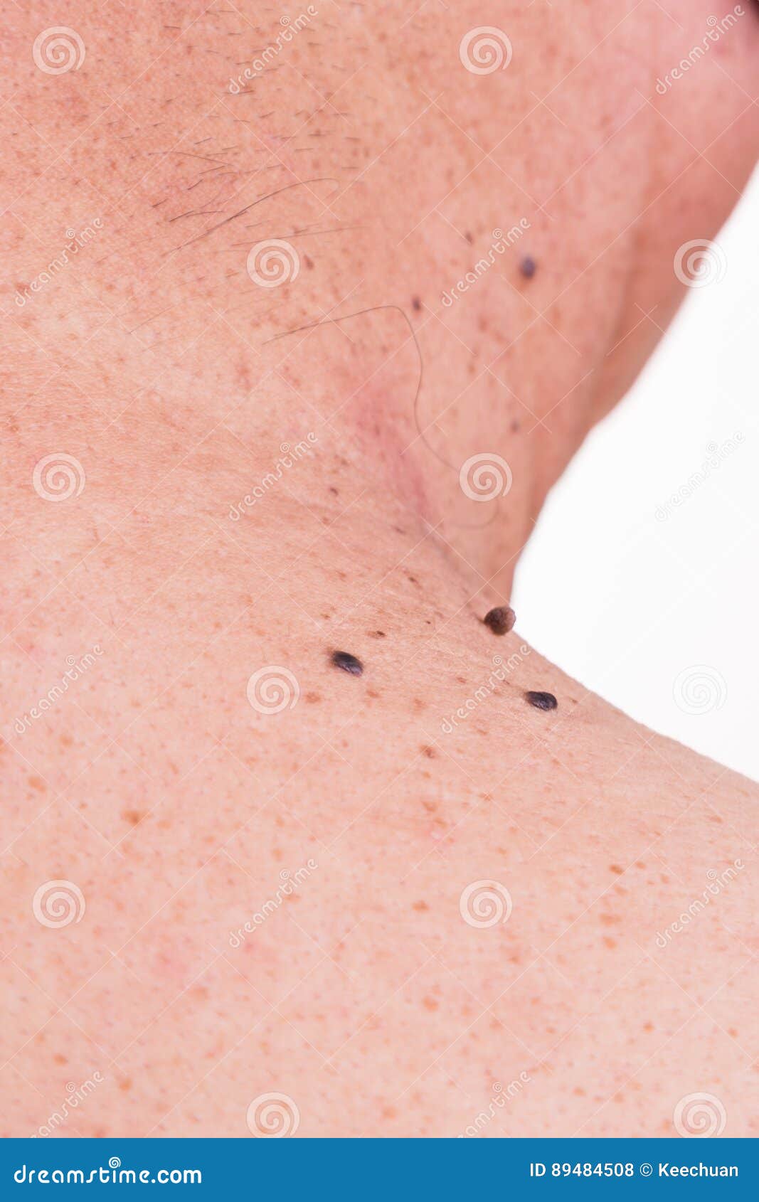 Multiple Mole on Neck and Shoulder of Asian Male Stock Photo - Image of ...