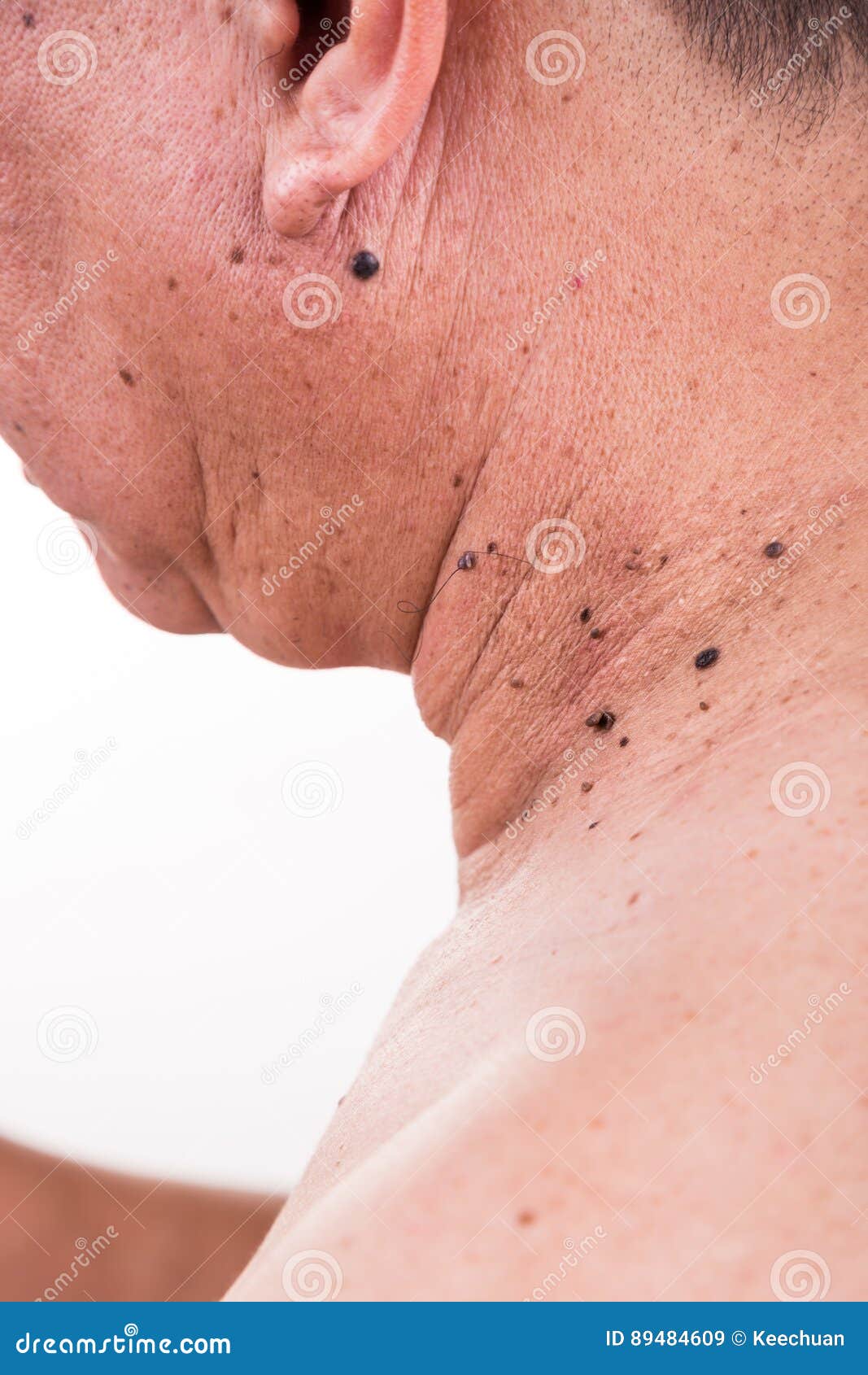 Multiple Mole on Neck and Shoulder of Asian Male Stock Image - Image of ...