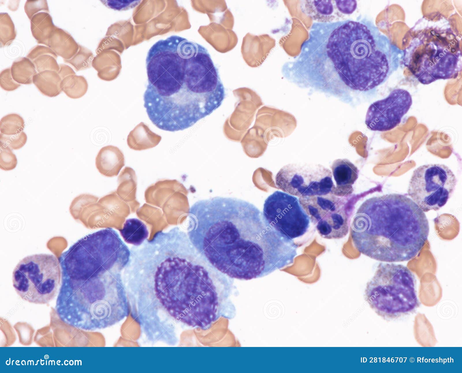 Plasmablastic Myeloma, Bone Marrow. Stock Illustration - Illustration ...