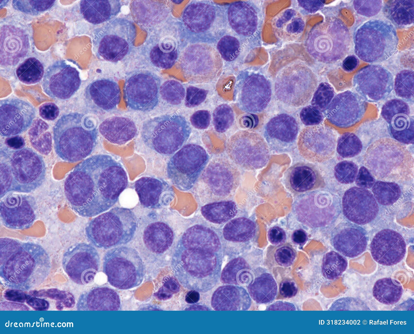Multiple Myeloma in the Bone Marrow. Stock Photo - Image of marrow ...