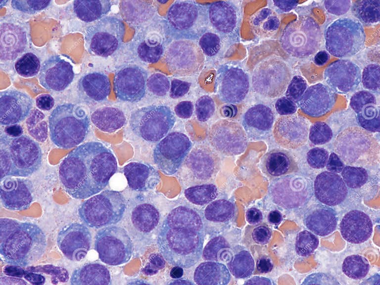Multiple Myeloma in the Bone Marrow. Stock Photo - Image of marrow ...