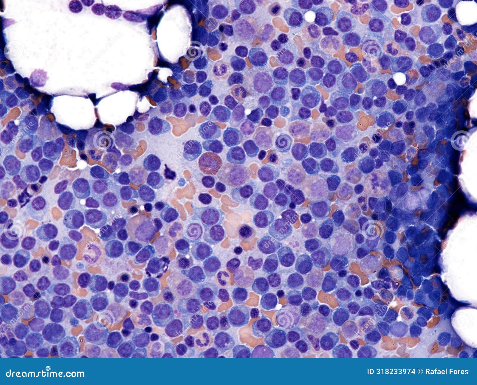 Multiple Myeloma in the Bone Marrow. Stock Photo - Image of monoclonal ...