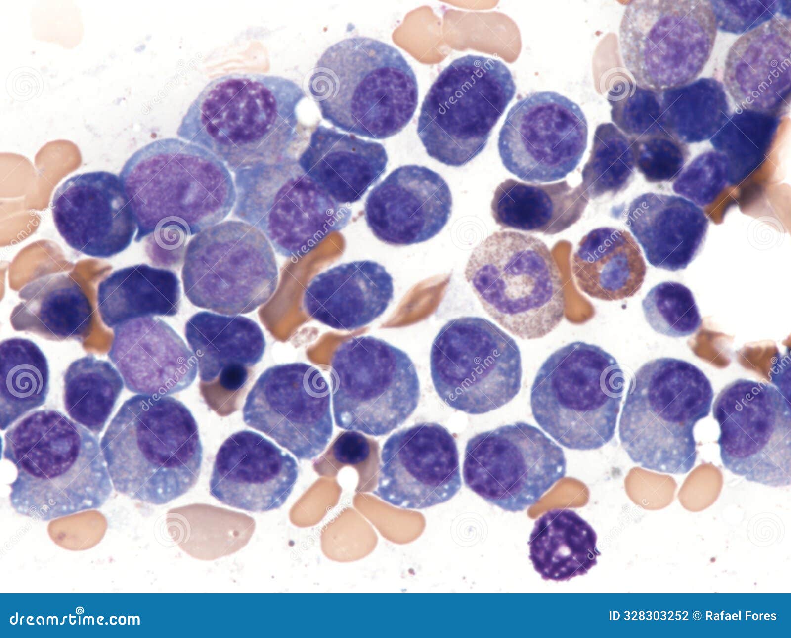 Multiple Myeloma in the Bone Marrow. Stock Photo - Image of tumor ...