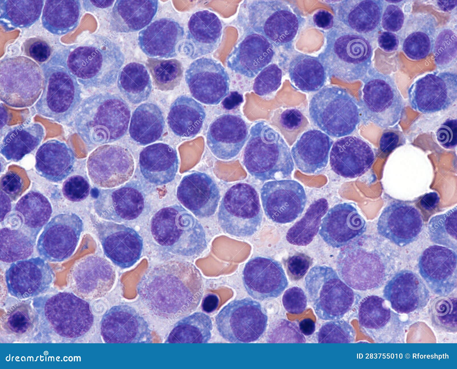 Multiple Myeloma in Bone Marrow. Stock Photo - Image of tumor, cytology ...