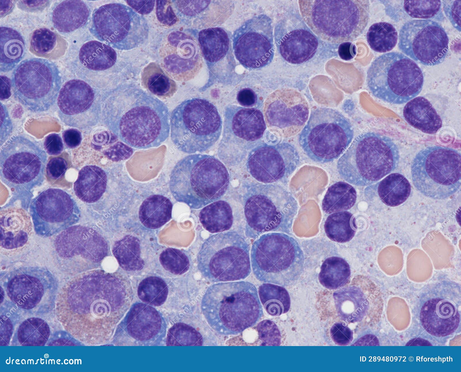 Multiple Myeloma in Bone Marrow Stock Photo - Image of cytology, cells ...