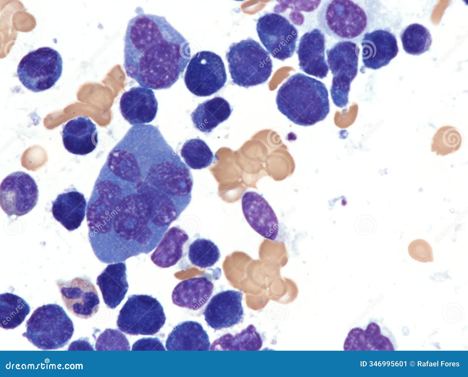 Multiple Myeloma in the Bone Marrow. Stock Image - Image of multiple ...