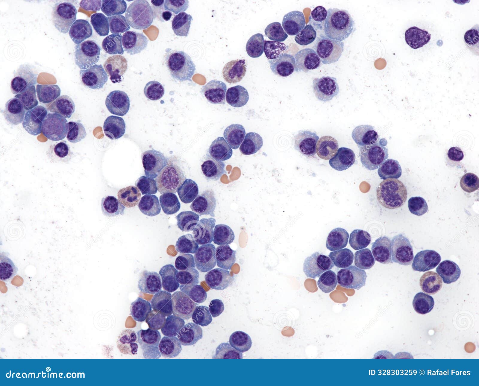 Multiple Myeloma in the Bone Marrow. Stock Image - Image of tumor ...