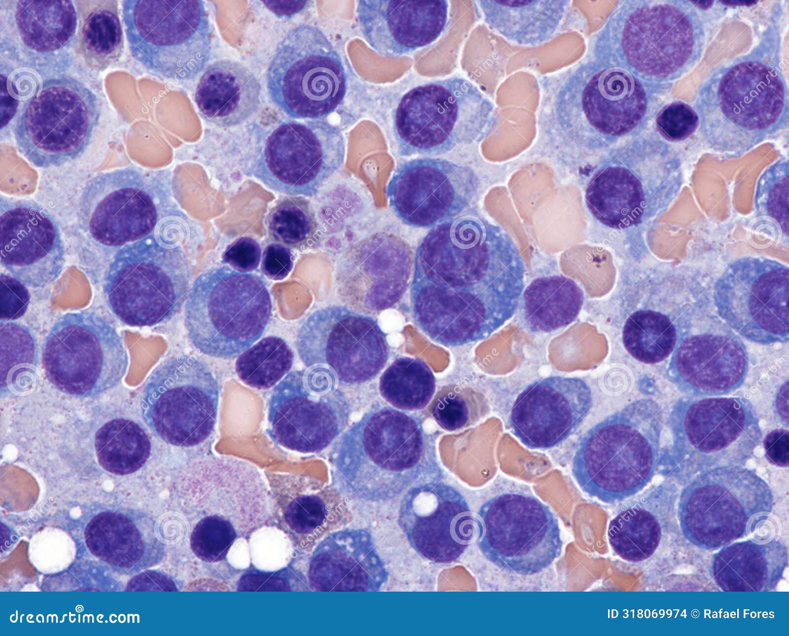 Multiple Myeloma in the Bone Marrow. Stock Photo - Image of tumor ...