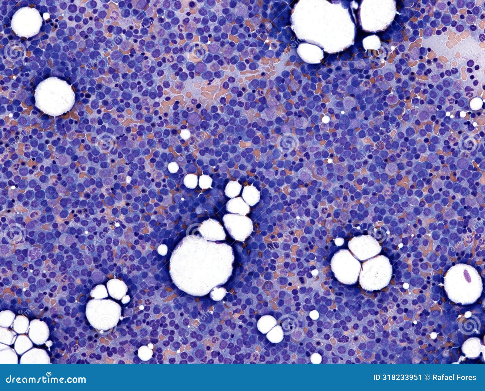 Multiple Myeloma in the Bone Marrow. Stock Image - Image of myeloma ...