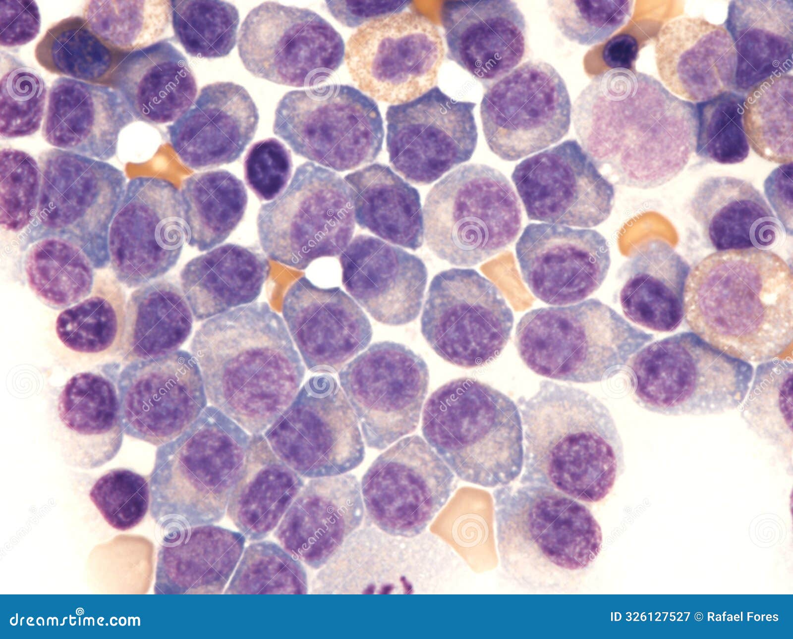 Multiple Myeloma in the Bone Marrow. Stock Image - Image of marrow ...