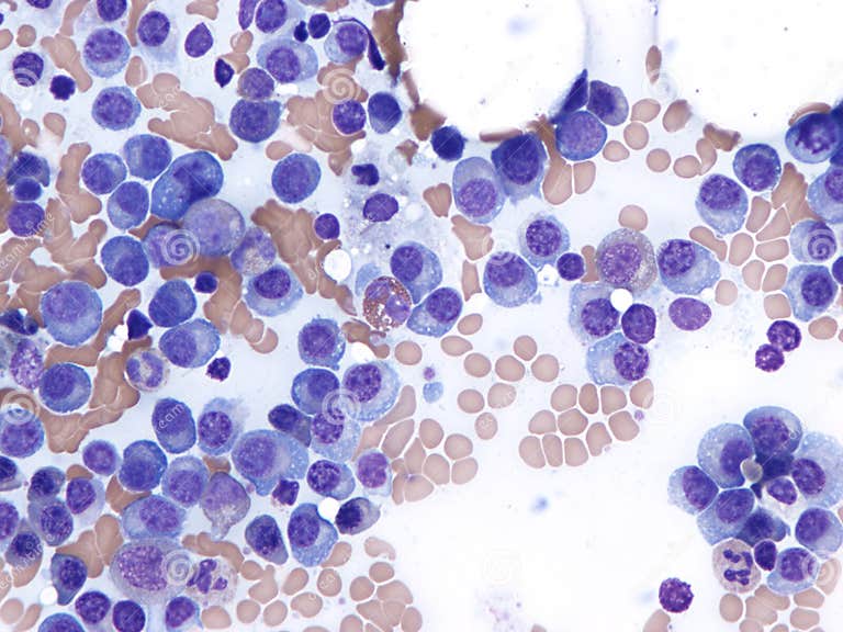 Multiple Myeloma in the Bone Marrow. Stock Image - Image of ...