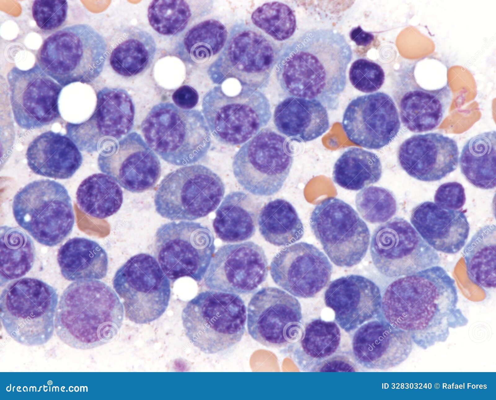 Multiple Myeloma in the Bone Marrow. Stock Photo - Image of myeloma ...