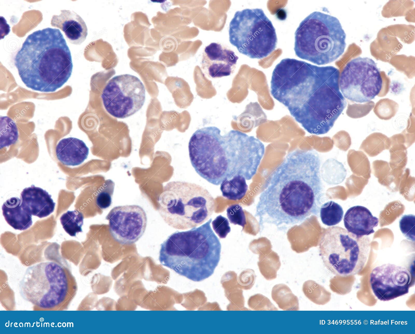 Multiple Myeloma in the Bone Marrow. Stock Photo - Image of clinical ...
