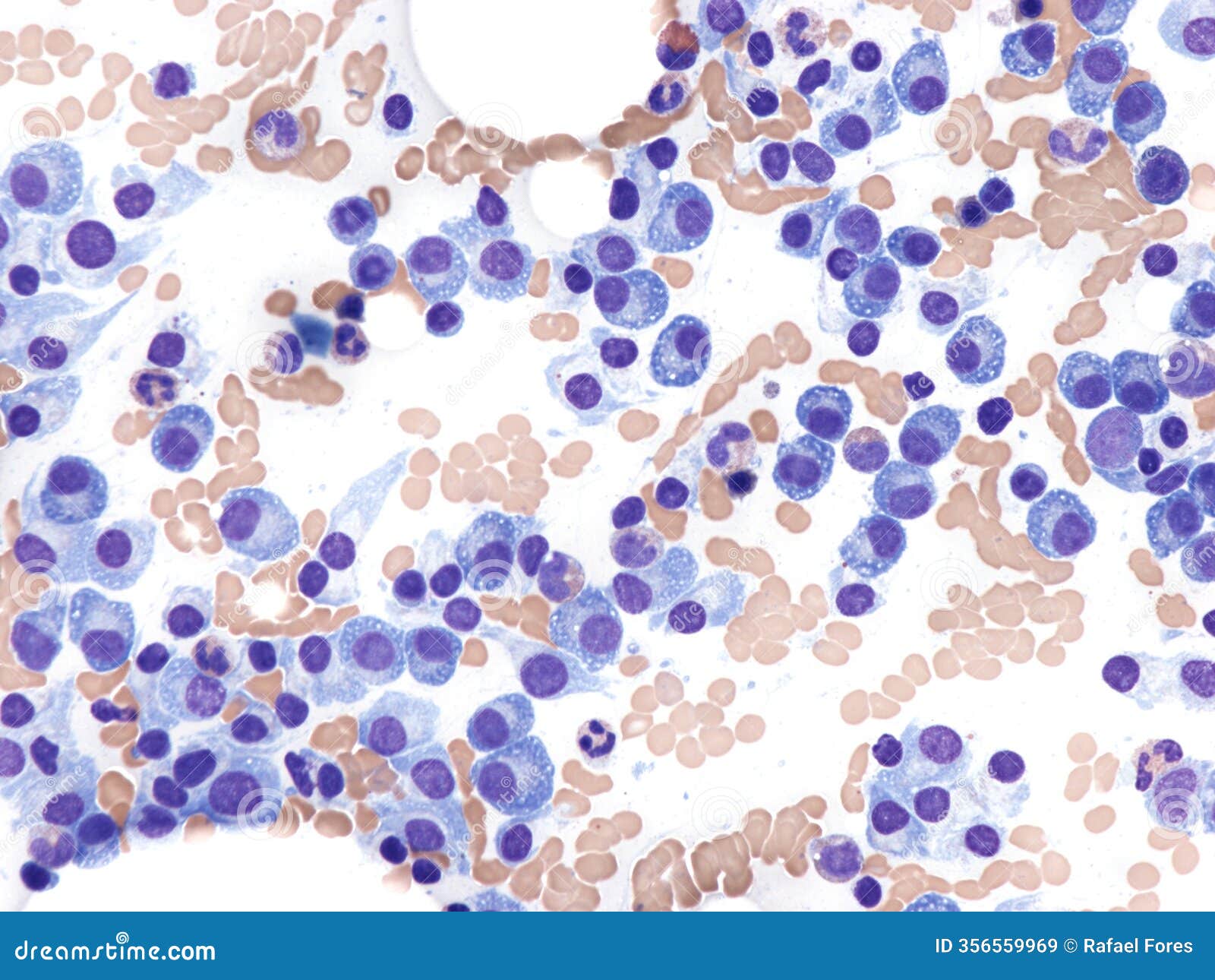 Multiple Myeloma in the Bone Marrow. Stock Image - Image of ...