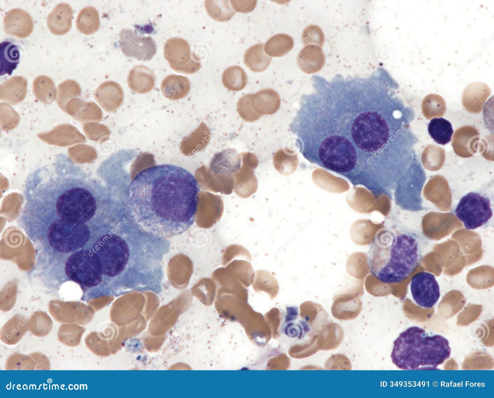 Multinucleated Plasma Cells. Multiple Myeloma. Stock Illustration ...