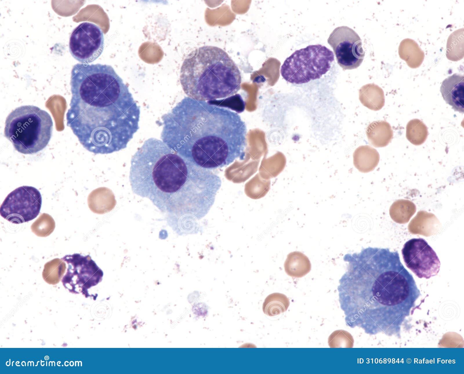 Multiple myeloma stock photo. Image of medical, cells - 310689844