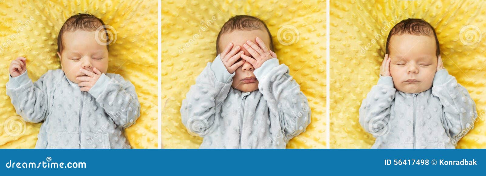 Bilateral Little Finger Deviation In Asian Young Man. Bilateral Hand ...