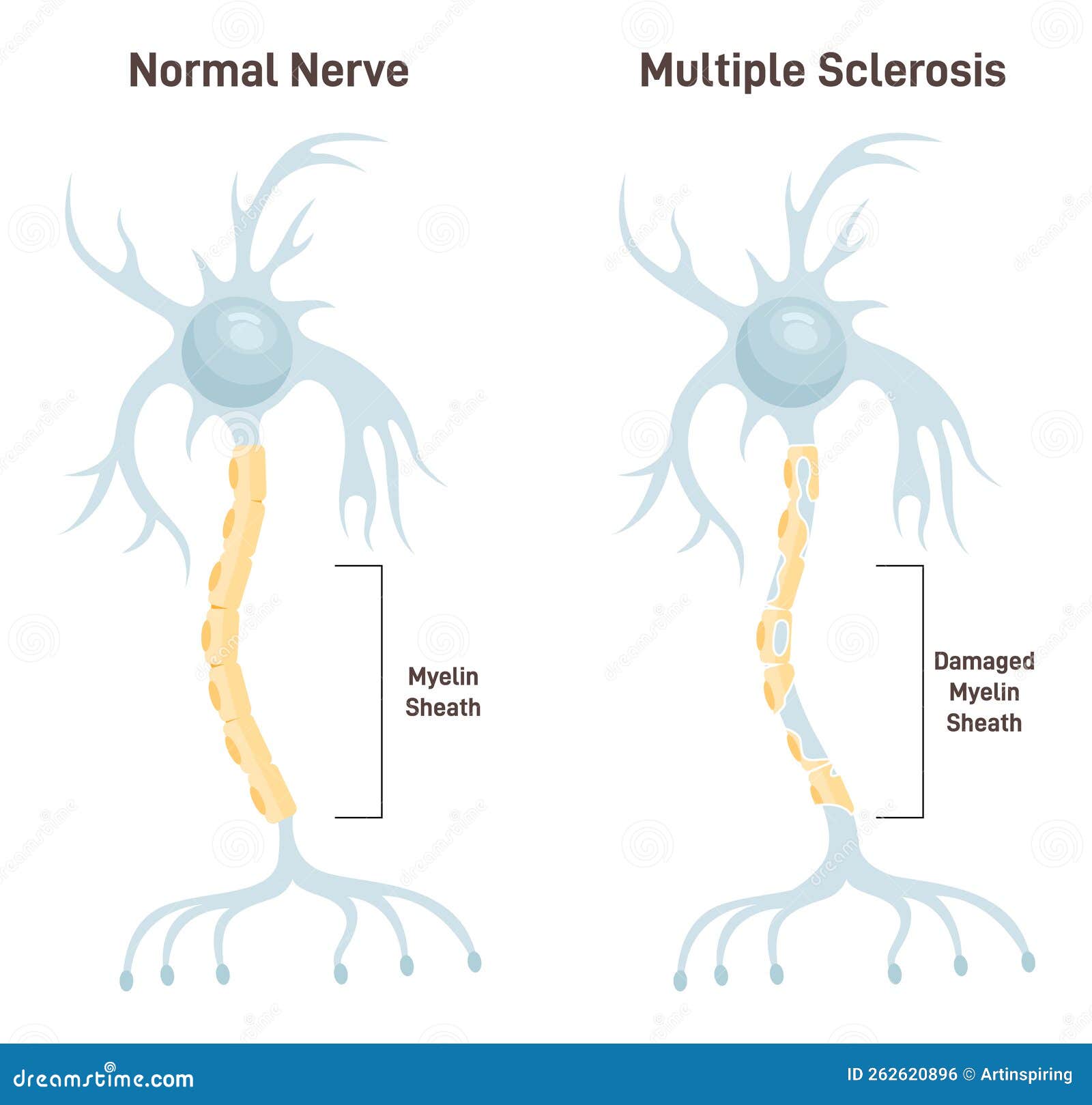 Multiple Sclerosis. Autoimmune Disease Affecting the Central Nervous ... Multiple Sclerosis. Autoimmune Disease Affecting the Central Nervous ...