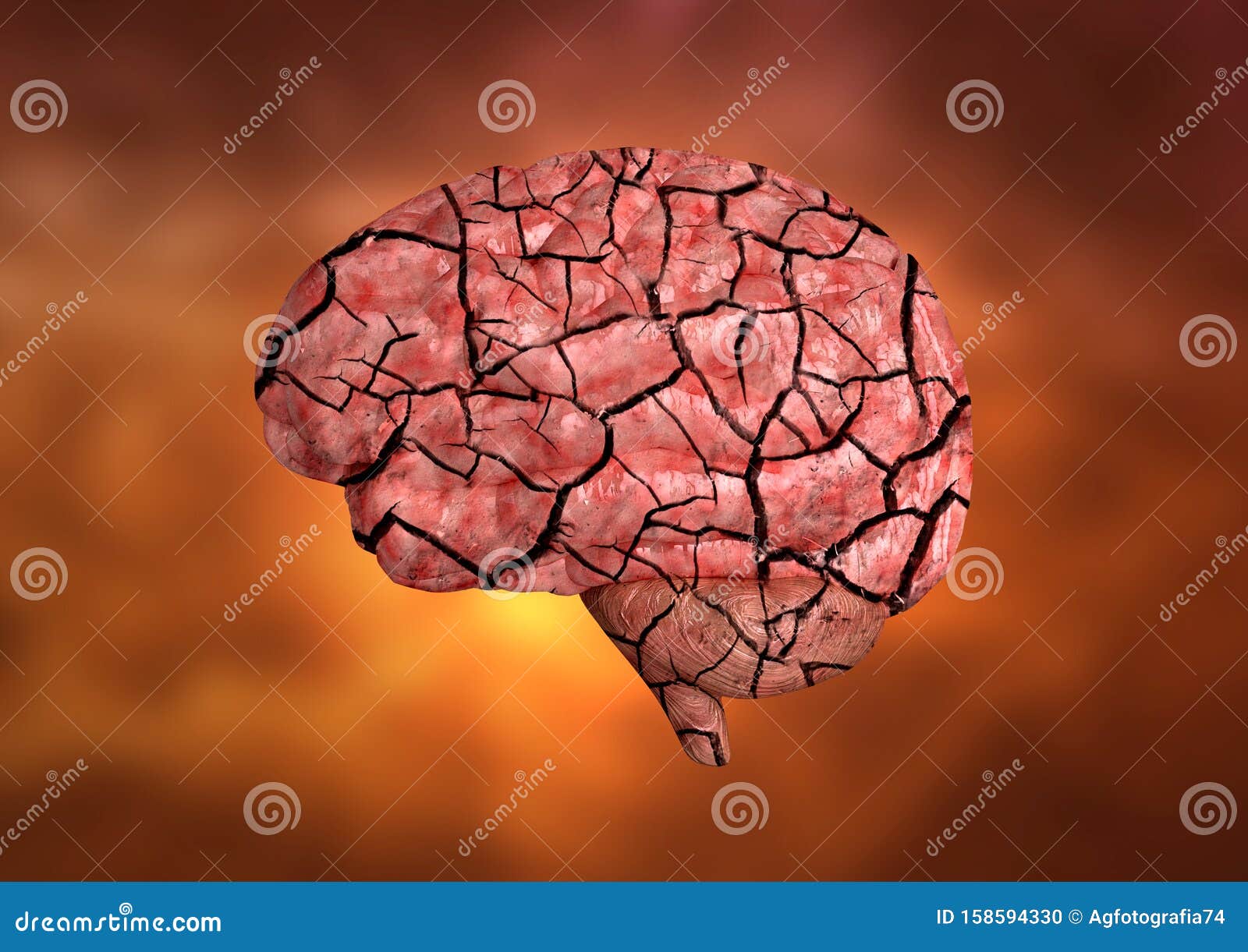 Multiple Sclerosis is an Autoimmune Disease that Affects the Brain ... Multiple Sclerosis is an Autoimmune Disease that Affects the Brain ...
