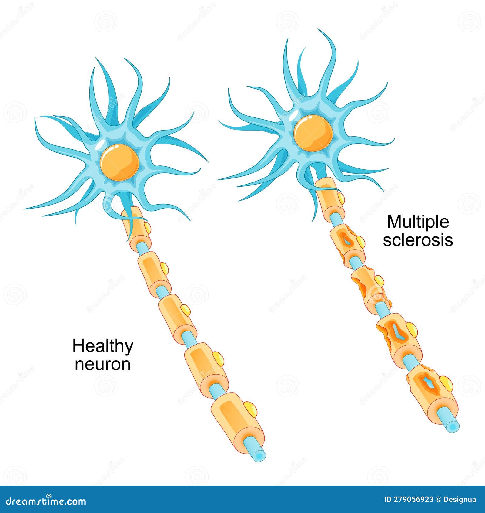Multiple Sclerosis. Autoimmune Disease Stock Vector - Illustration of ...