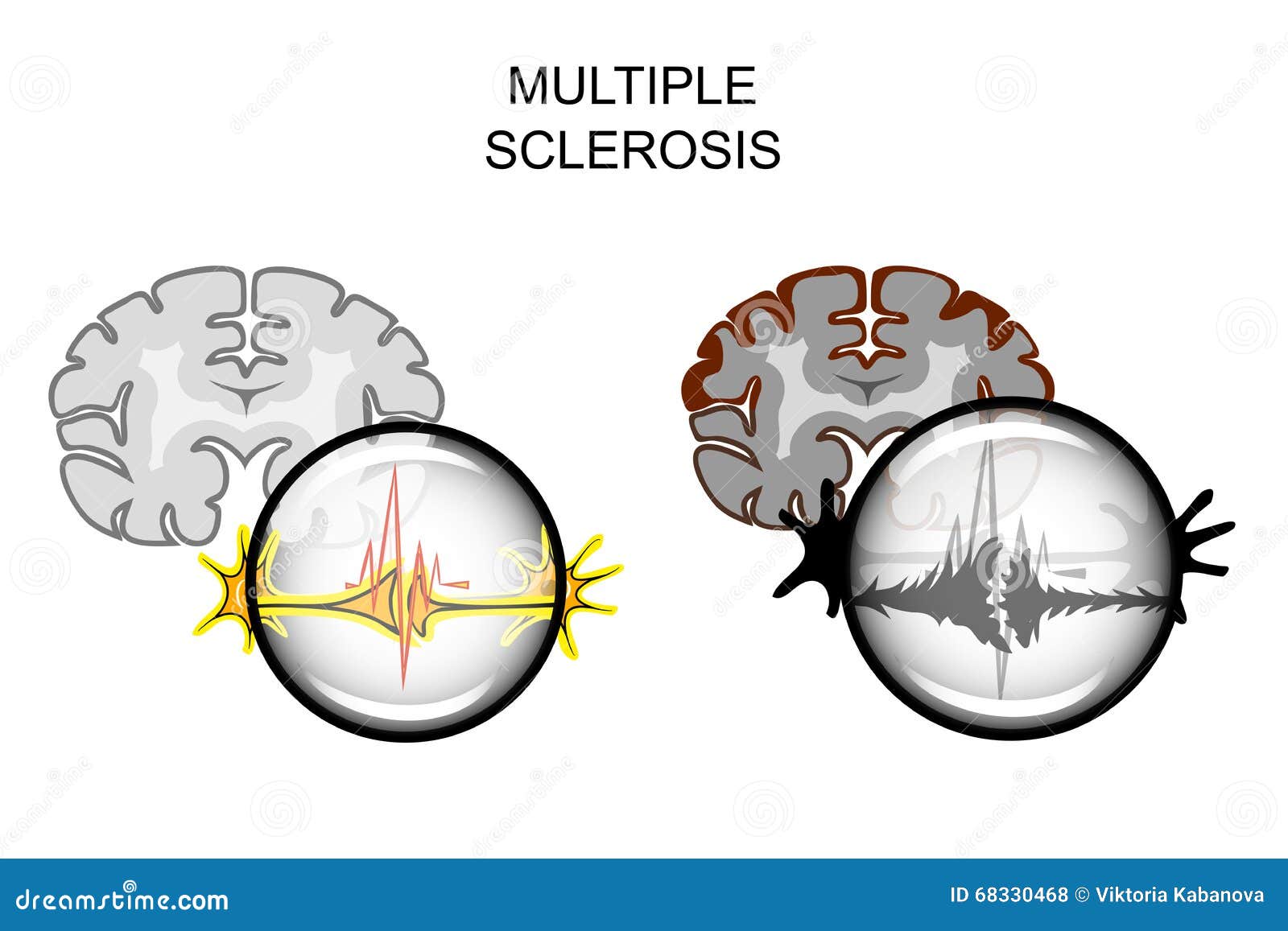 Brain Affected By Multiple Sclerosis, MRI Scan Illustration Cartoon ...