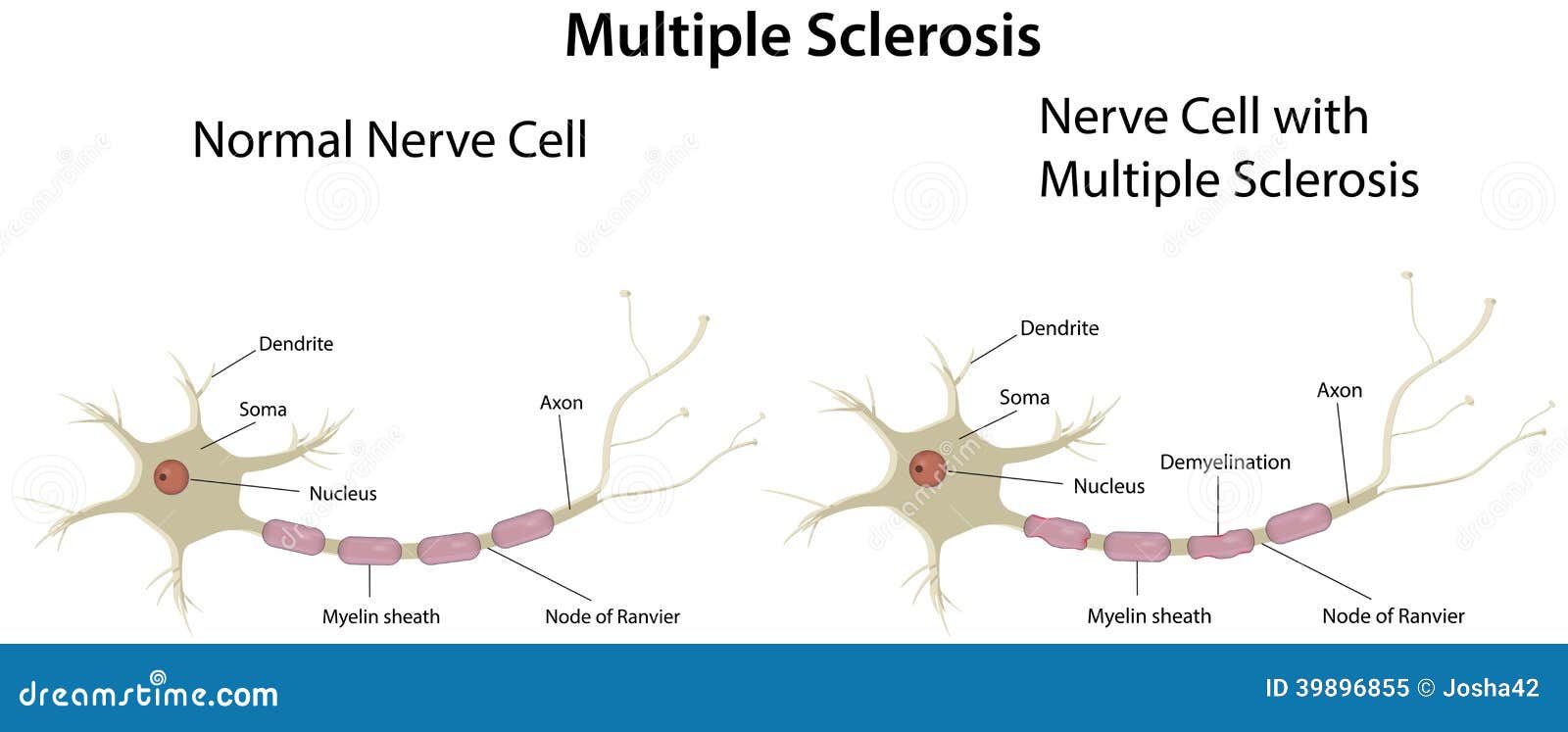 Multiple Sclerosis Diagram stock vector. Illustration of pathology ... Multiple Sclerosis Diagram stock vector. Illustration of pathology ...