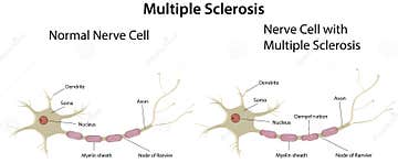 Multiple Sclerosis Diagram stock vector. Illustration of pathology ...