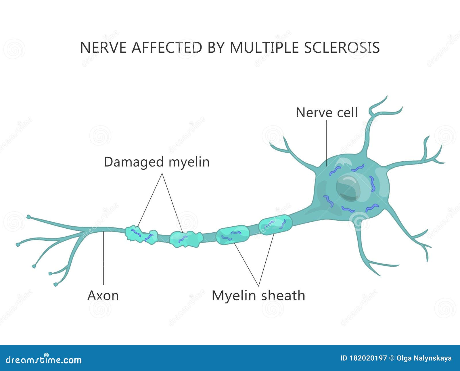 Multiple Sclerosis Failure Myelin Cells Autoimmune Disease Stock Vector ...