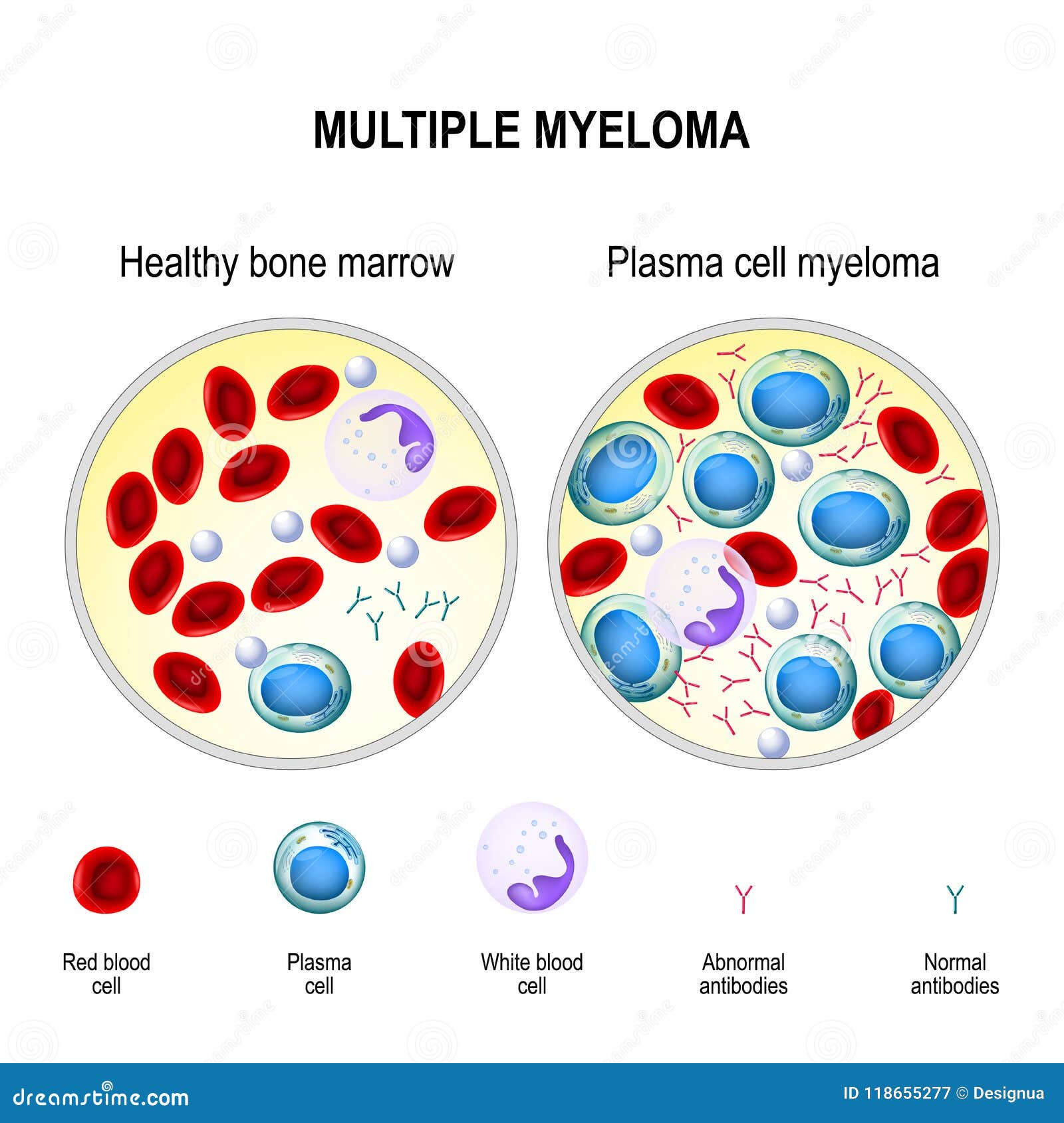 Multiples Myeloma Plasmazellenmyeloma Vektor Abbildung - Illustration ...