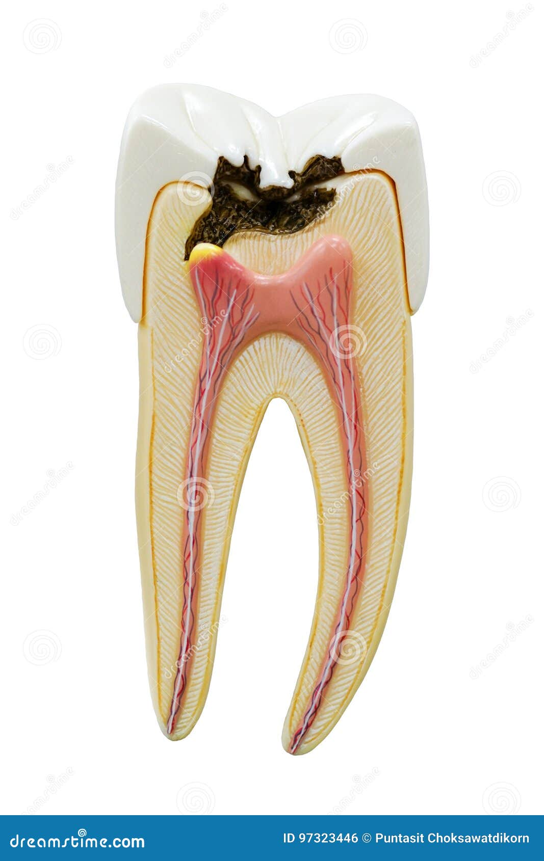 Murken tandmodell arkivfoto. Bild av ortodontisk, stängning - 97323446