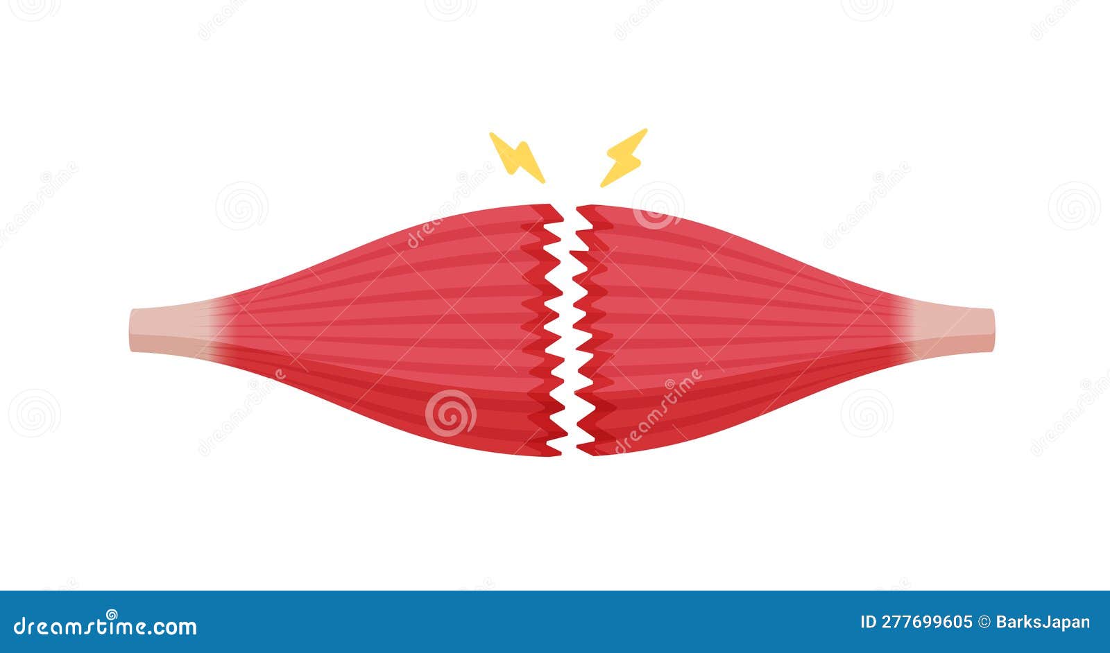 Muscle Rupture Vector Illustration ( Complete Tear | CartoonDealer.com ...