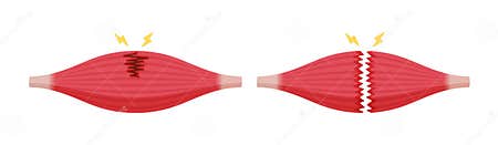 Muscle Rupture Vector Illustration (partial and Complete Tears Stock ...