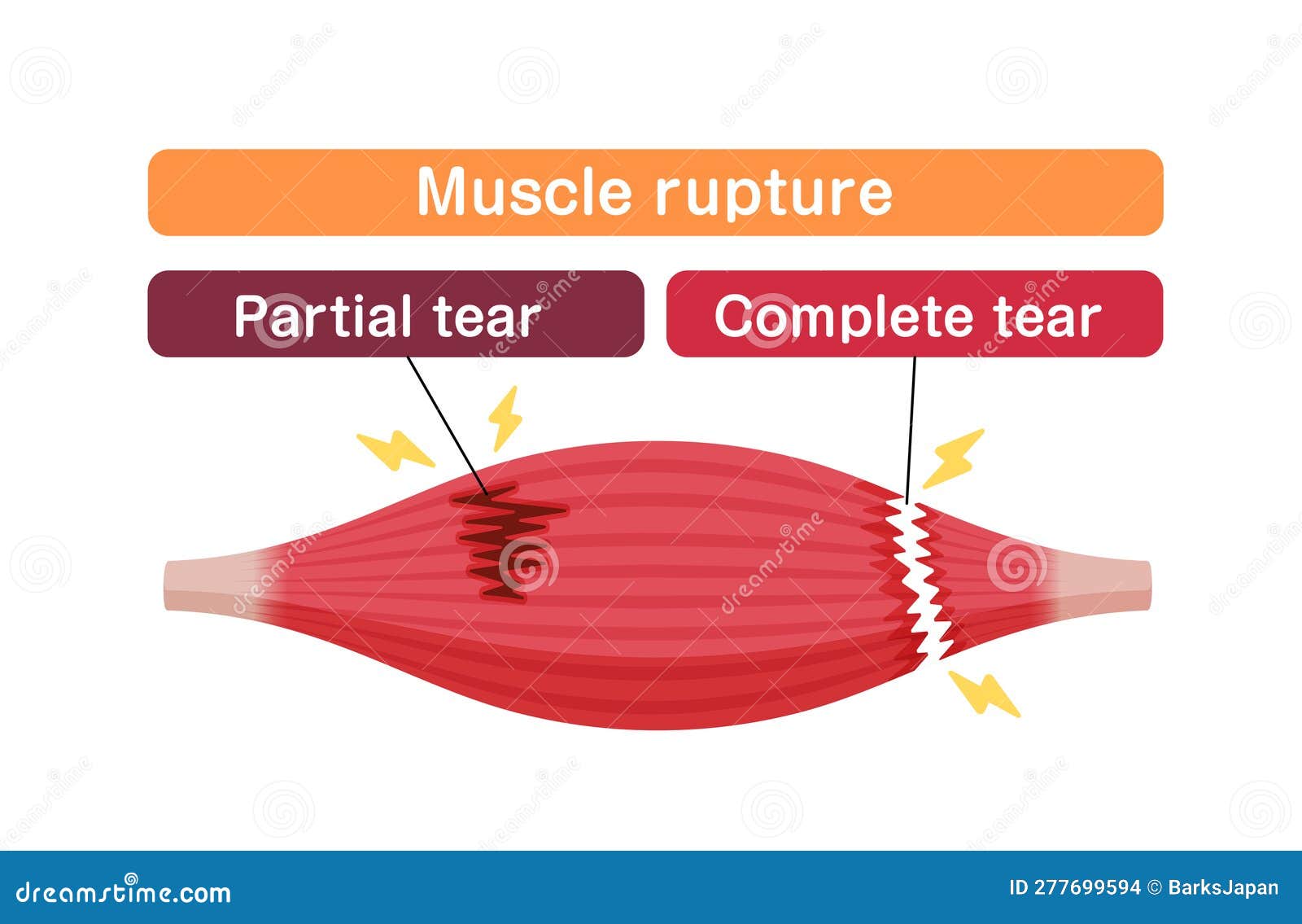 Muscle Rupture Vector Illustration (partial And Complete Tears ...