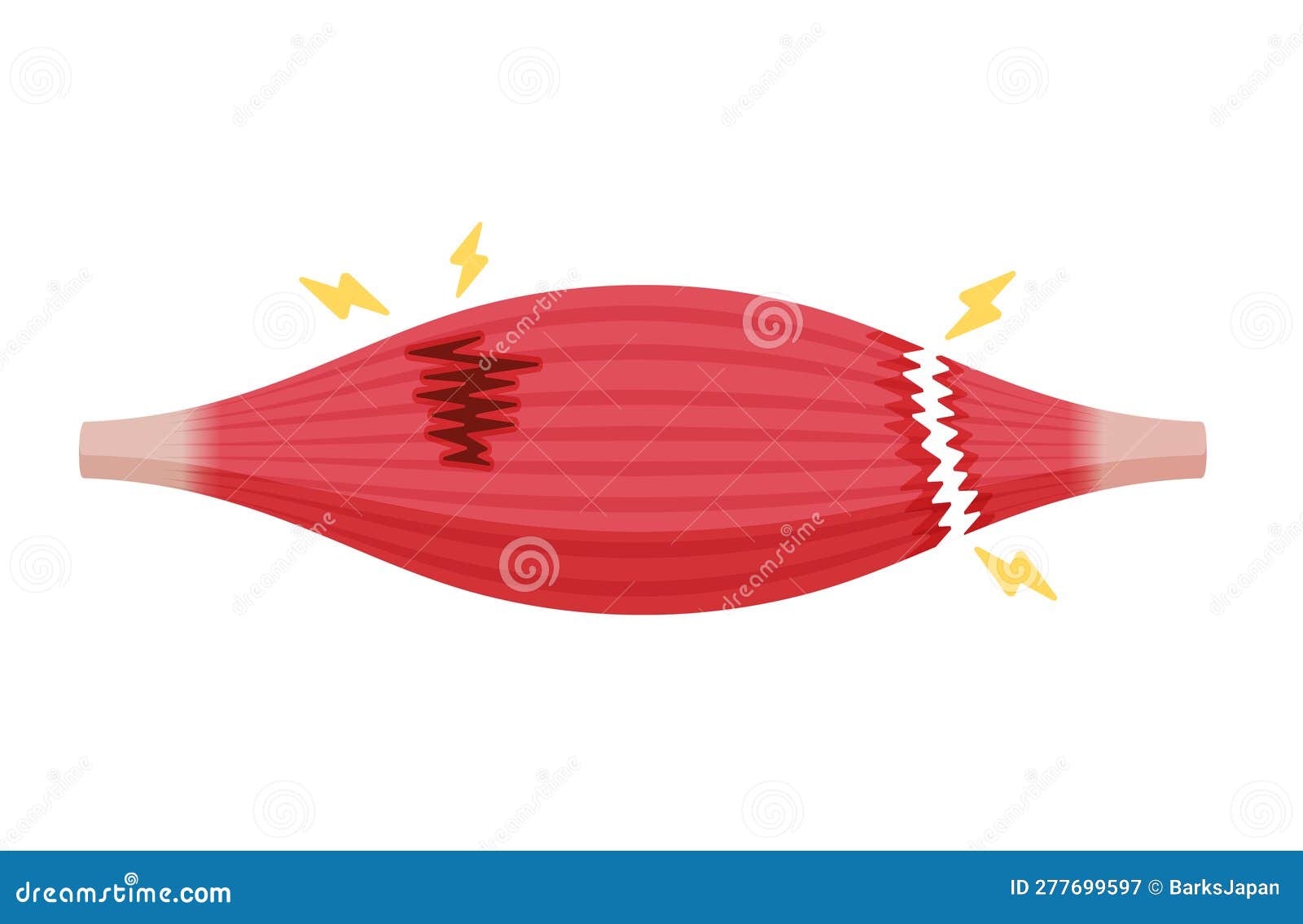 Muscle Rupture Vector Illustration (partial And Complete Tears ...