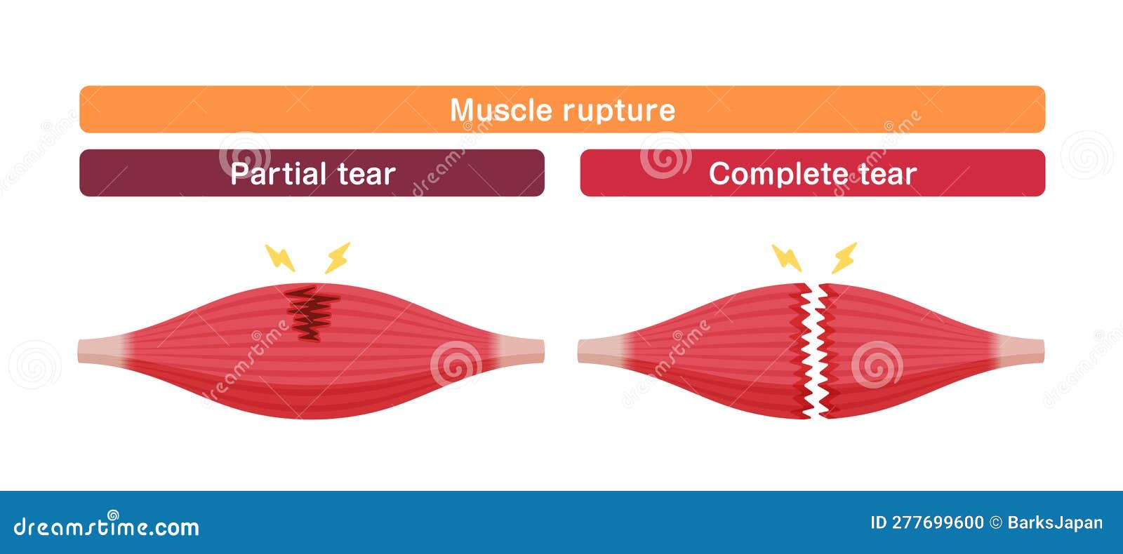 Muscle Rupture Vector Illustration (partial And Complete Tears ...