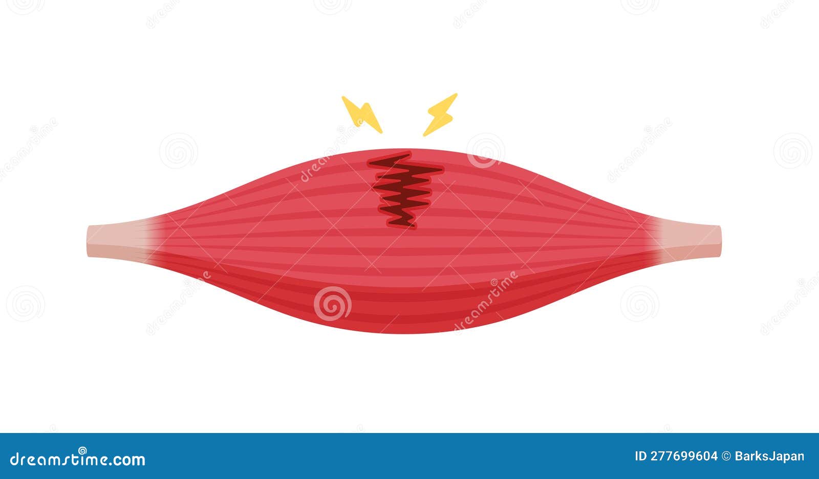 Muscle Rupture Vector Illustration (partial And Complete Tears ...