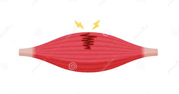 Muscle Rupture Vector Illustration (partial Tear Stock Vector ...