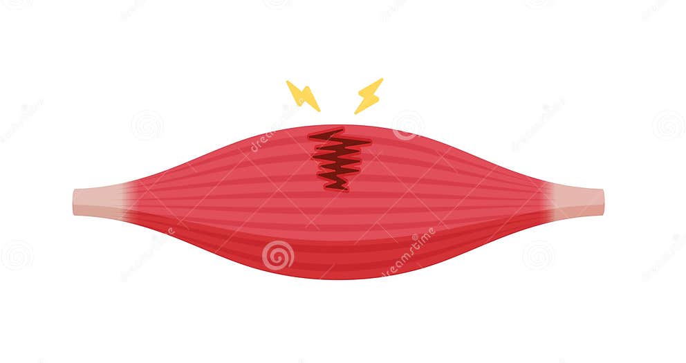 Muscle Rupture Vector Illustration (partial Tear Stock Vector ...