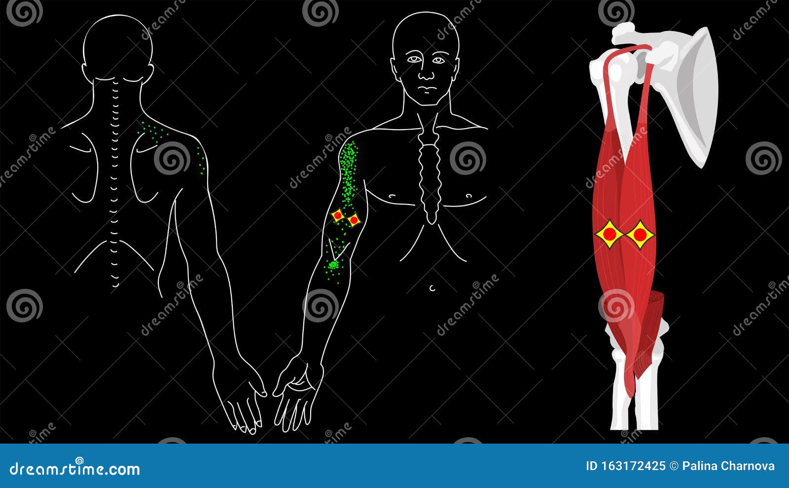 Musculus Biceps Brachii. Biceps Trigger Points and Pain Stock ...